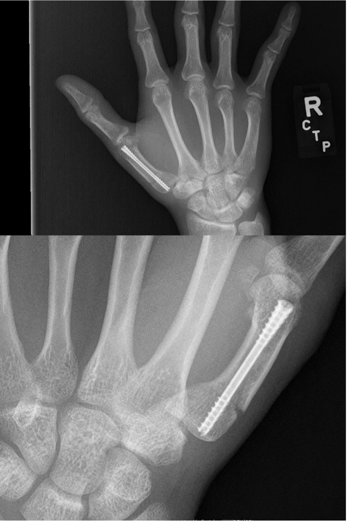 Use of NX Nail for Open Reduction and Fixation of 1st Metacarpal Shaft Fracture